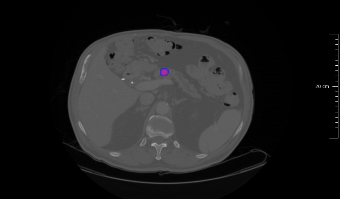 MHub - The New Deployment Standard for Medical Imaging AI