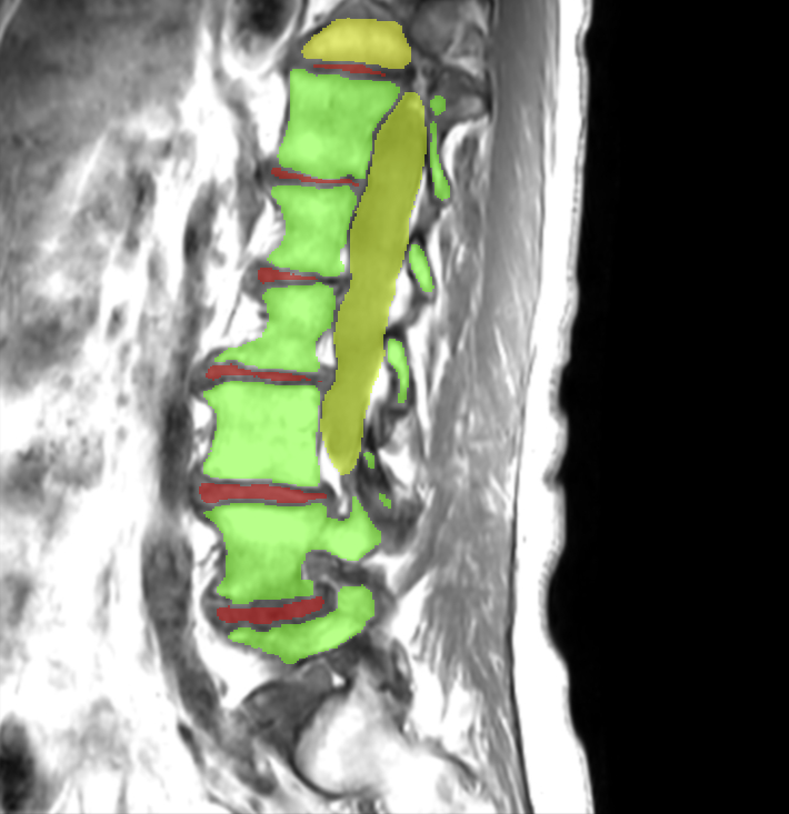 MHub - The New Deployment Standard for Medical Imaging AI