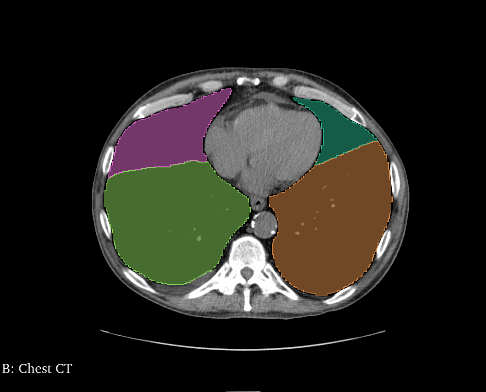 MHub - The New Deployment Standard for Medical Imaging AI