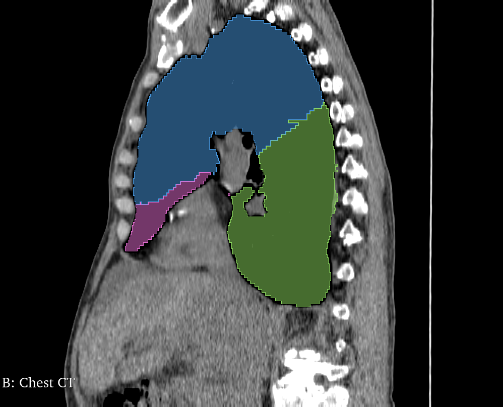 MHub - The New Deployment Standard for Medical Imaging AI