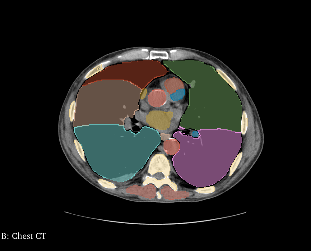 MHub - The New Deployment Standard for Medical Imaging AI