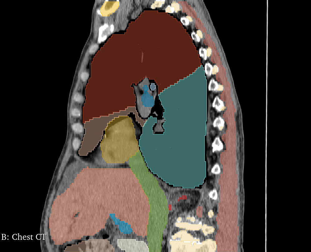 MHub - The New Deployment Standard for Medical Imaging AI