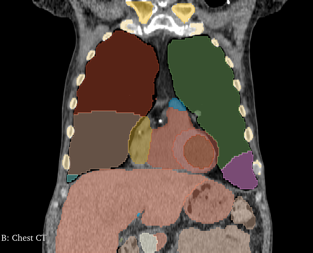 MHub - The New Deployment Standard for Medical Imaging AI